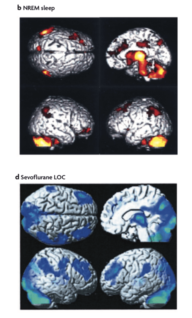 You’re getting sleepy: Brain mechanisms of anesthesia and natural sleep ...