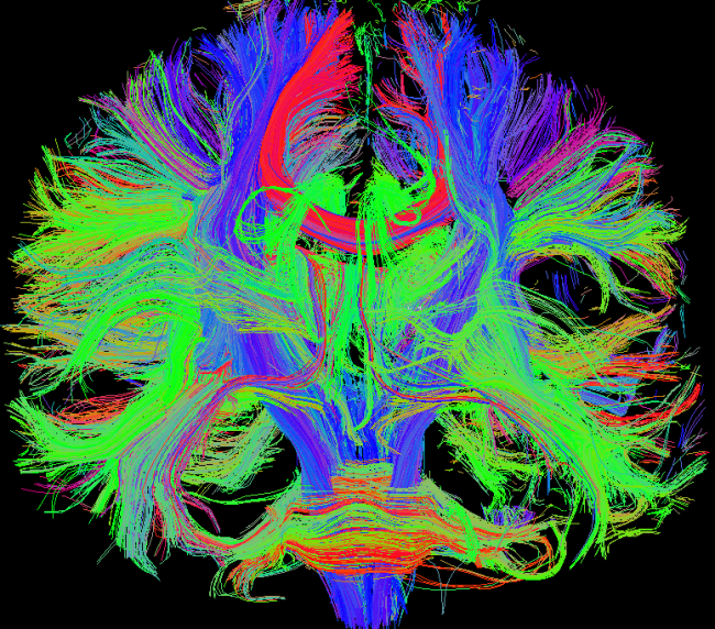 Diffusion MRI: Mapping the structural highways of the brain | NeuWrite ...
