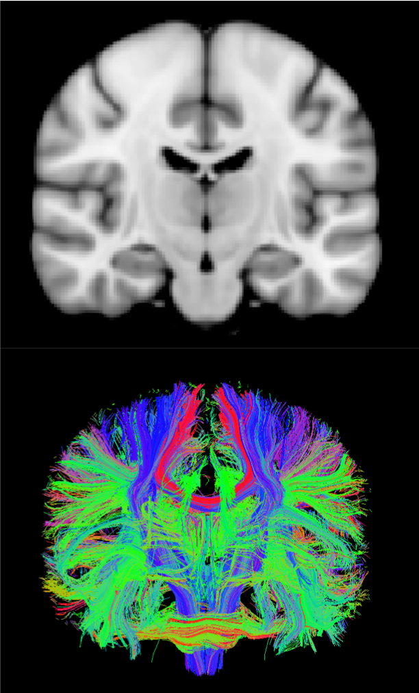 Diffusion MRI: Mapping the structural highways of the brain | NeuWrite ...