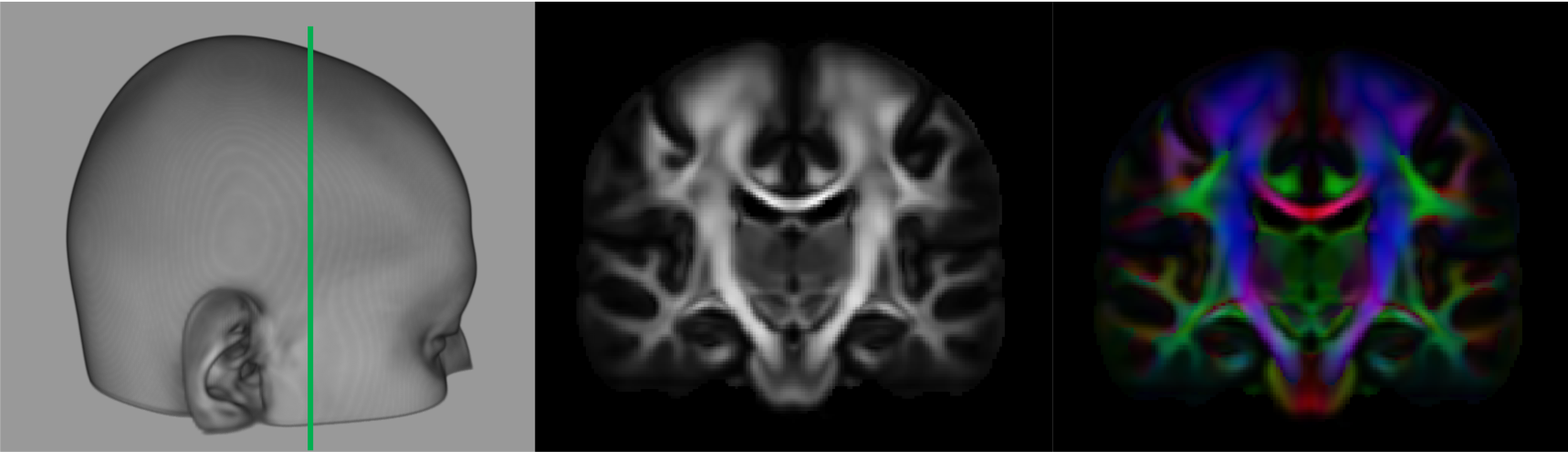 Diffusion MRI: Mapping the structural highways of the brain | NeuWrite ...