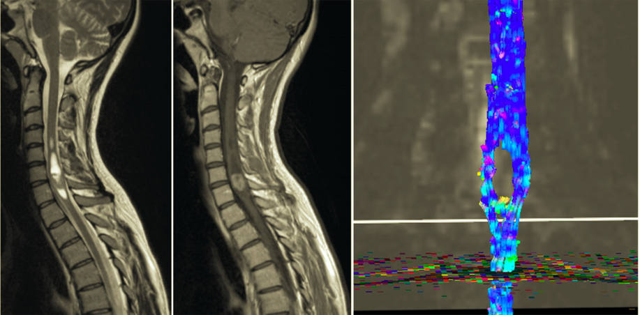 Diffusion MRI: Mapping the structural highways of the brain | NeuWrite ...